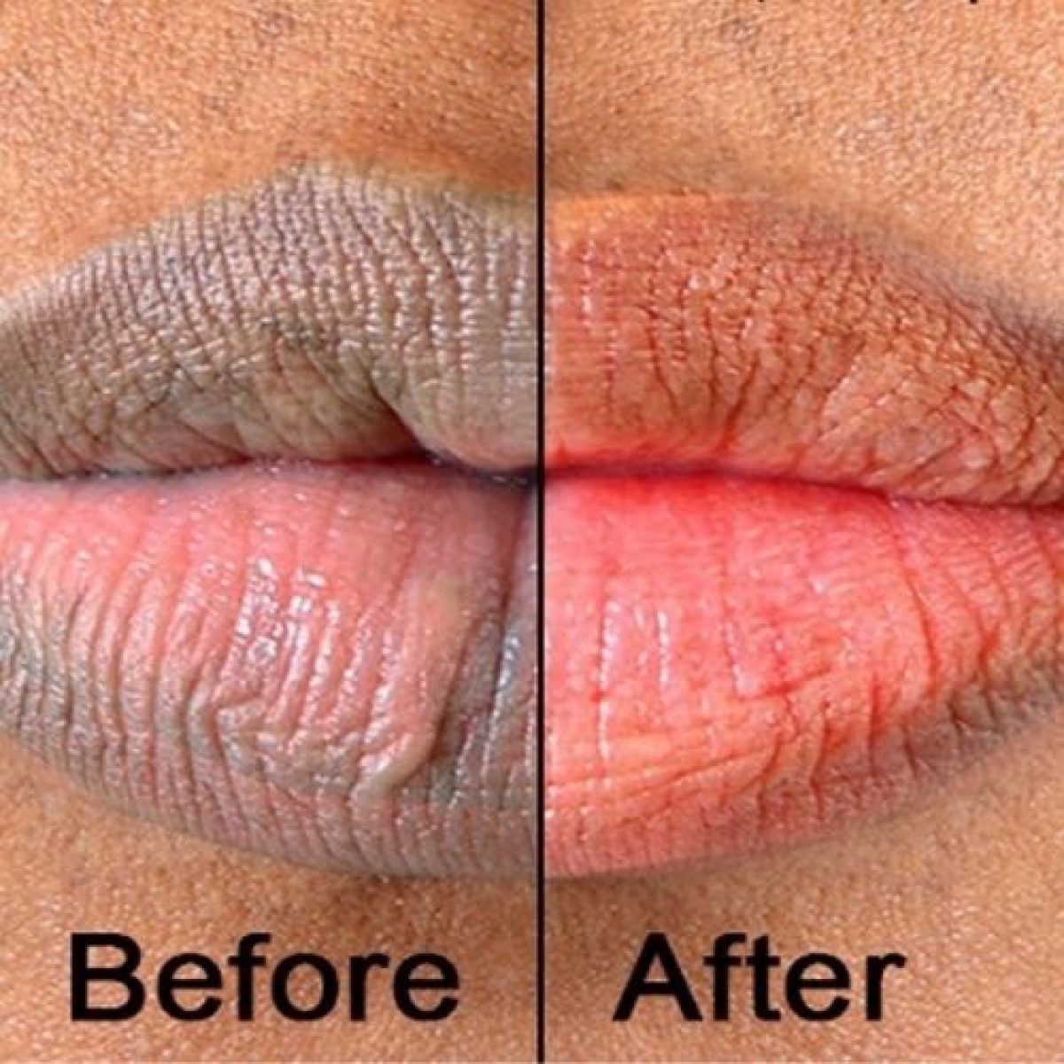Laser Lip Depigmentation - Turkish Private Clinics